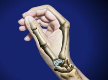 Basal Joint Surgery - KOC Ortho
