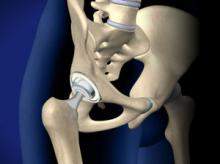 Total Hip Replacement, Anterior Approach - KOC Ortho