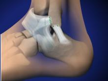 Lateral Ankle Ligament Reconstruction - KOC Ortho