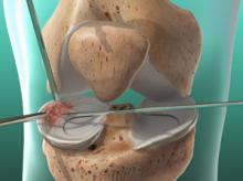 Meniscus Repair (Arthroscopic Technique) - KOC Ortho