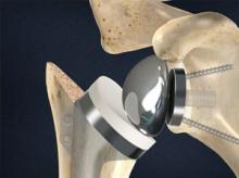 Reverse Total Shoulder Replacement - KOC Ortho