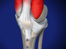 Tibial Tubercle Osteotomy - KOC Ortho