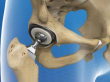 Total Hip Replacement - KOC Ortho