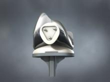 Total Knee Replacement - KOC Ortho